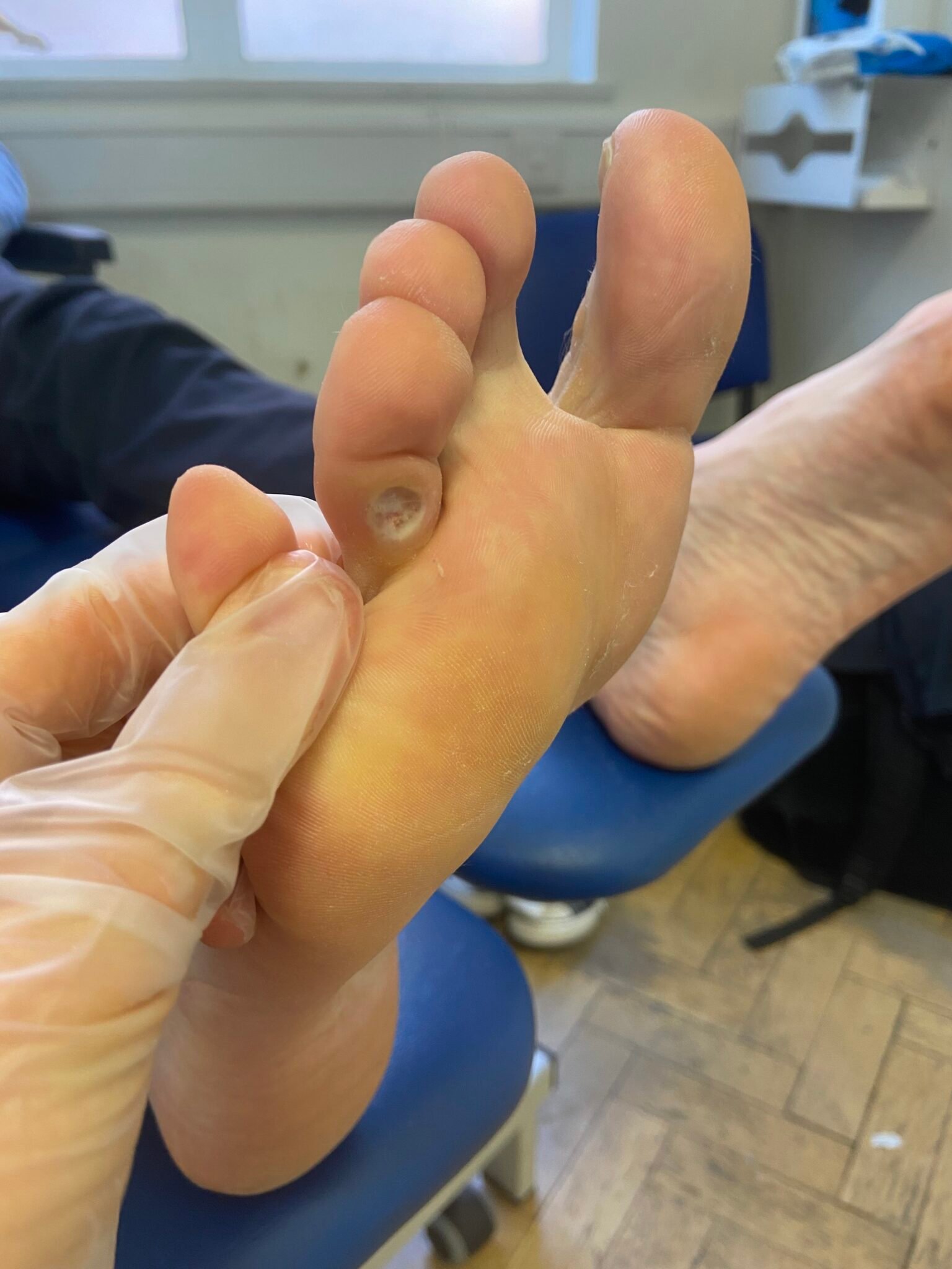 How to Remove a Corn from a Diabetic Foot: Safe Steps - Diabetes Diet Life